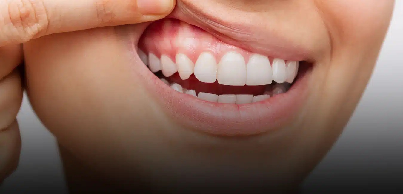 Periodontal Treatment in Poway, CA | Pomerado Family Dental